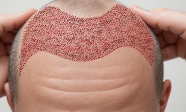 10 Klinik Terbaik untuk Implan Rambut di Indonesia [2022 Prices]